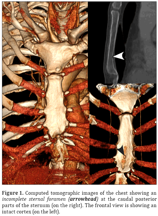A case of an incomplete sternal foramen
