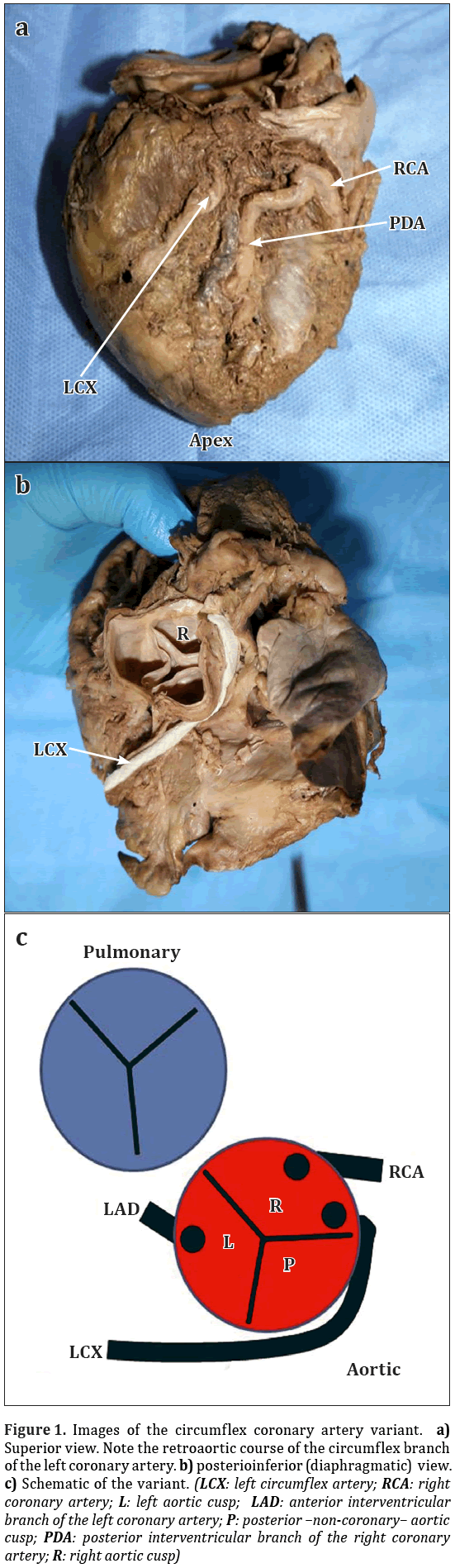 Variant aortic sinusal origin of the left circumflex coronary artery