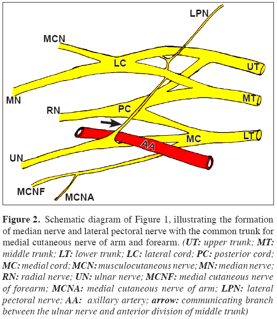 Formation of median nerve without the medial root of medial cord and ...