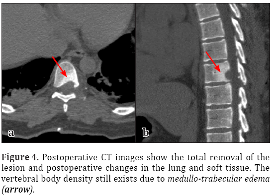 Osteoid osteoma of the vertebral body: an unusual localization