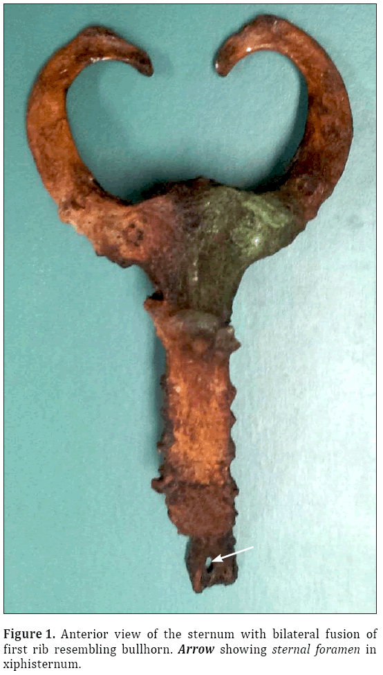 Bilateral fusion of first rib with sternum