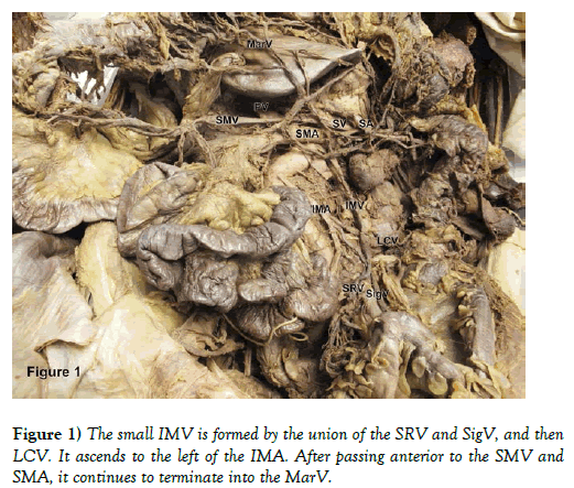 A rare variation of the inferior mesenteric vein with clinical implications