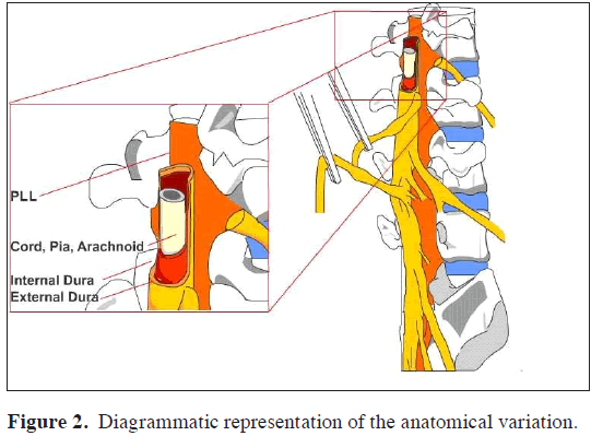 Double spinal dural sheath: a cadaveric case reportThe