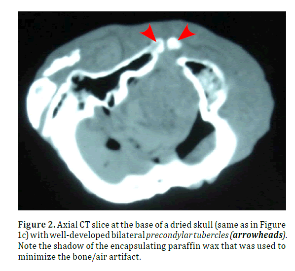 Anatomical and clinical correlates of the precondylar tubercle