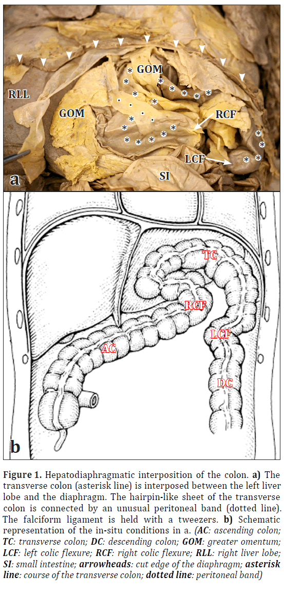 Hepatodiaphragmatic interposition of the colon: anatomical findings of ...