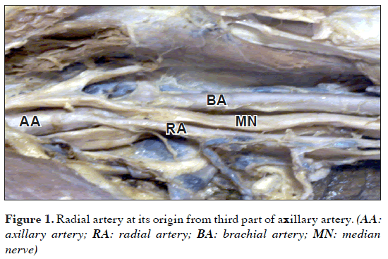 Unusual origin of the radial artery