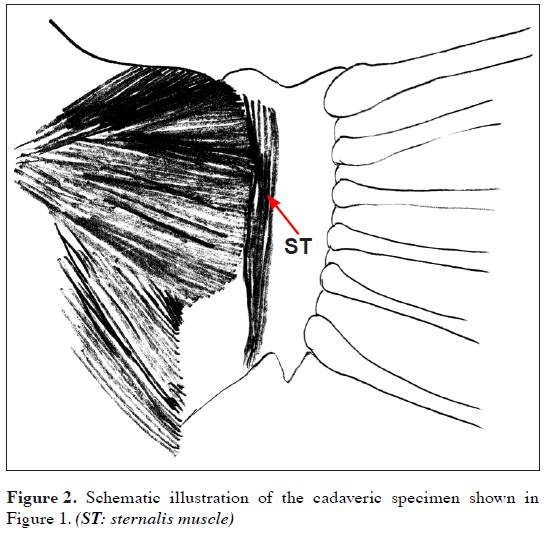 Sternalis muscle: importance of its awareness in chest imaging and ...