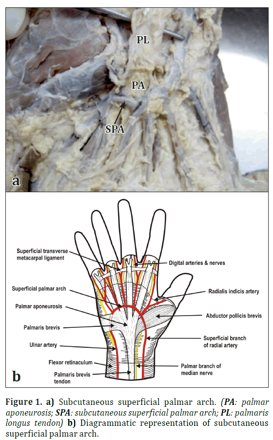 Subcutaneous superficial palmar arch - an unusual variant