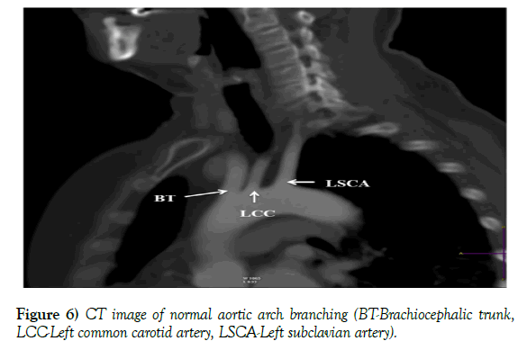 Normal Aortic Arch Anatomy