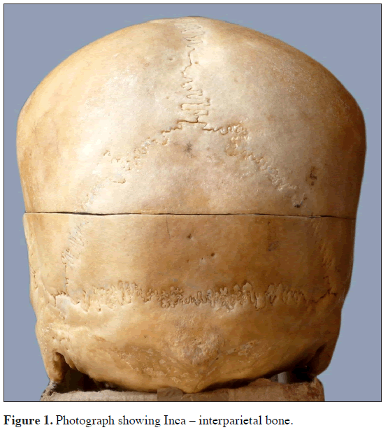 Interparietal (Inca) bone: a case report
