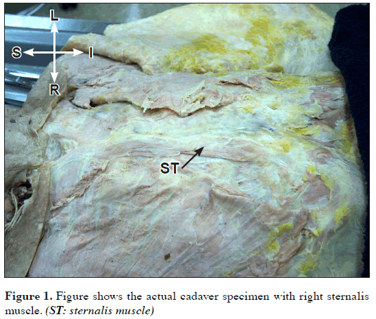 Sternalis muscle: importance of its awareness in chest imaging and ...