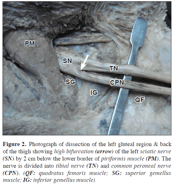 A case of a unilateral unusual genicular branch of the common peroneal ...