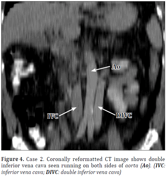 Report of two cases of double inferior vena cava with an emphasis on ...