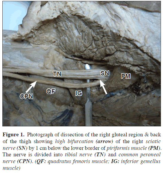 A case of a unilateral unusual genicular branch of the common peroneal ...