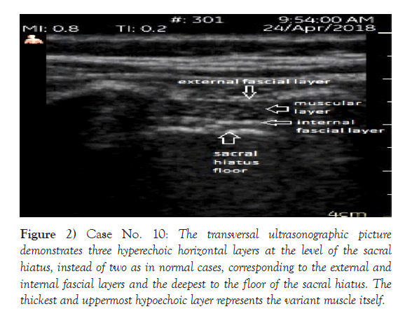 Variant muscular covering of the sacral hiatus