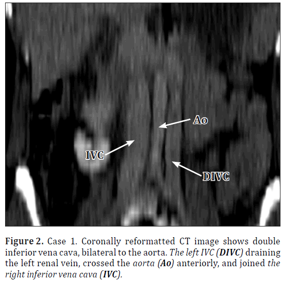 Report of two cases of double inferior vena cava with an emphasis on ...