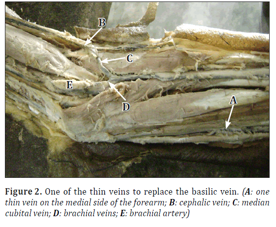 Neurovascular variations in the limbs of a single cadaver
