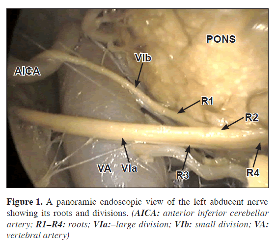 Four roots of abducent nerve at its exit from the pontomedullary sulcus ...