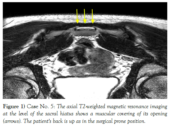 Variant muscular covering of the sacral hiatus