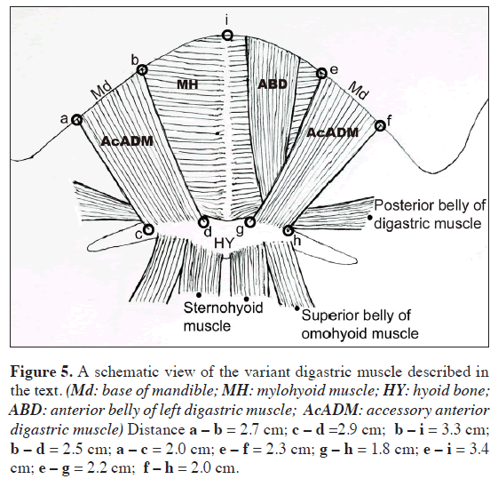 A variant digastric muscle
