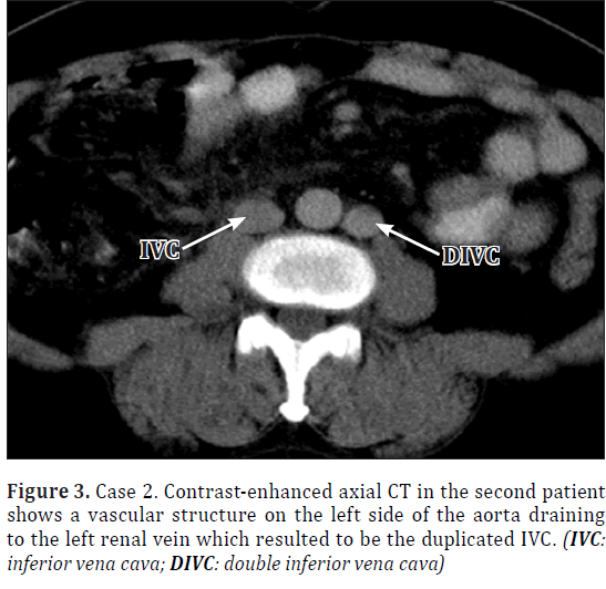 Report of two cases of double inferior vena cava with an emphasis on ...