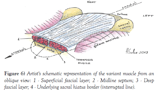 Variant muscular covering of the sacral hiatus