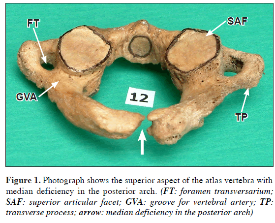 Median deficiency in the posterior arch of the atlas vertebra: a case ...