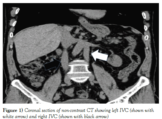 A rare presentation of duplicated inferior vena cava in a donor nephrectomy