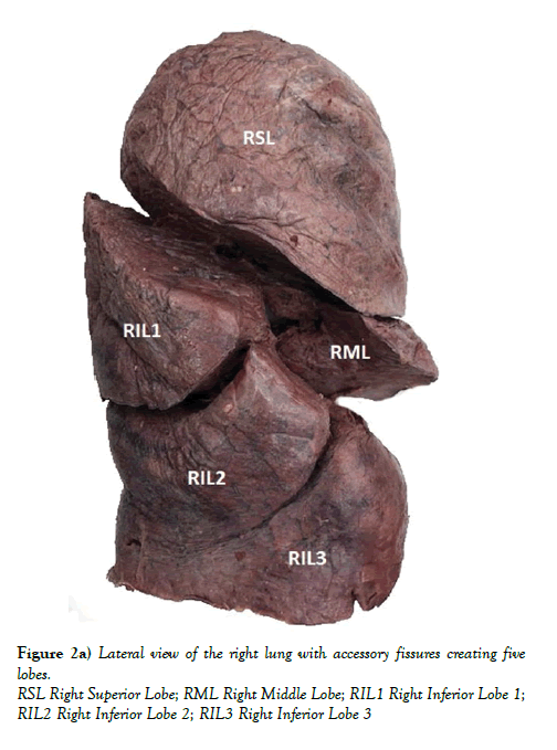 Anatomical lung variations: A study conducted on cadaveric specimens