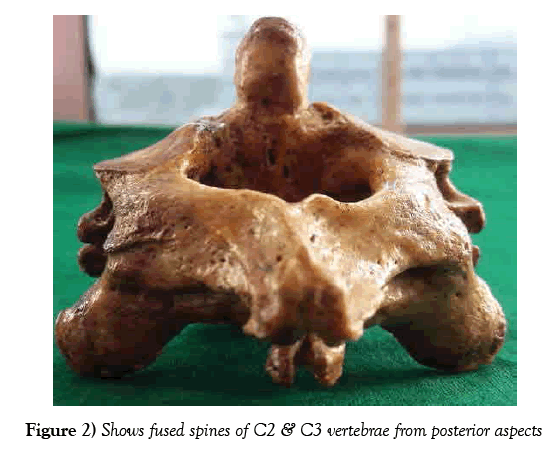 Congenital block vertebrae (C2 & C3) and its clinical significance–A ...
