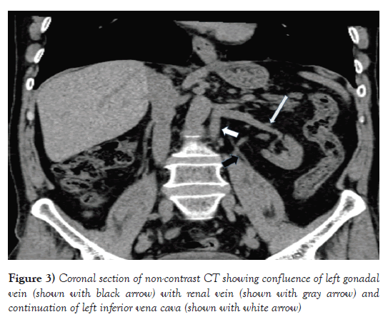 A rare presentation of duplicated inferior vena cava in a donor nephrectomy