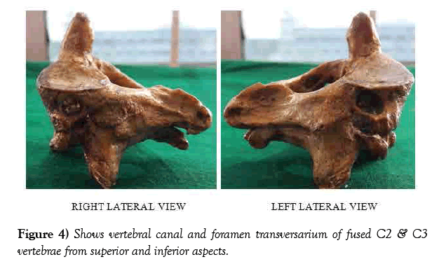 Congenital block vertebrae (C2 & C3) and its clinical significance–A ...