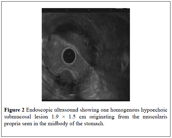 Incidental finding of Gastrointestinal Stromal Tumors (GISTs) during ...