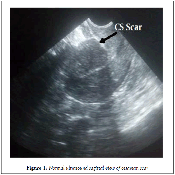 Cesarean scar characteristics after scheduled and emergency Cesarean ...