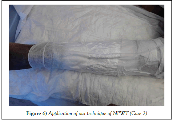 The use of economic negative-pressure wound therapy (NPWT) therapy ...