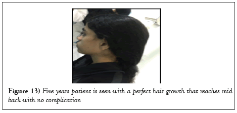 Multiple stage tissue expansion for reconstruction of scalp ...