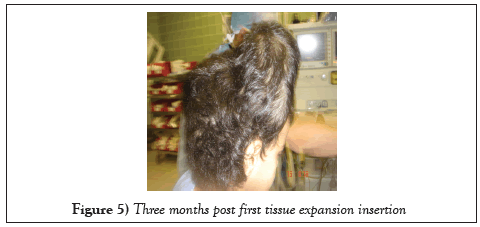 Multiple stage tissue expansion for reconstruction of scalp ...