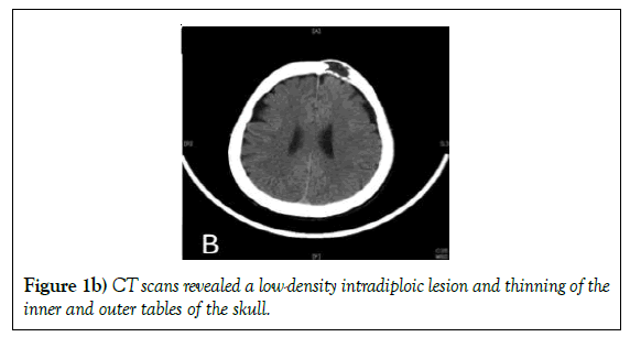 Non-traumatic intradiploic arachnoid cyst with growing swelling on the ...