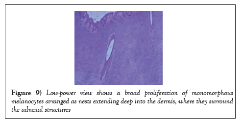 Multiple stage tissue expansion for reconstruction of scalp ...
