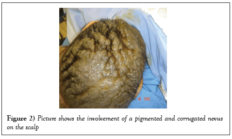 Multiple stage tissue expansion for reconstruction of scalp ...