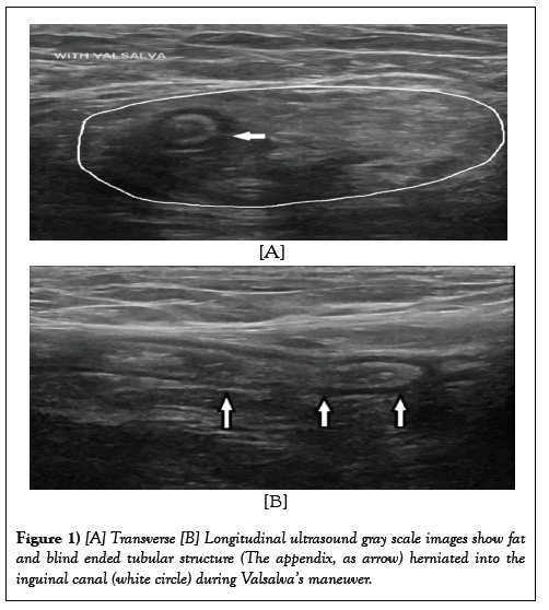 Enterocutaneous Fistula Of The Right Groin Area Followi